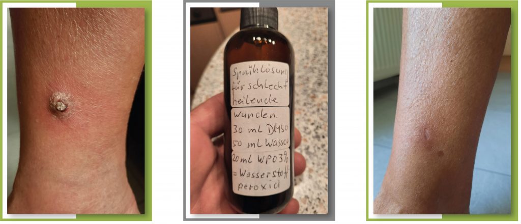Operation unnötig – „Verdächtige“ Hautstelle heilt mit DMSO/H2O2 - PraNatu